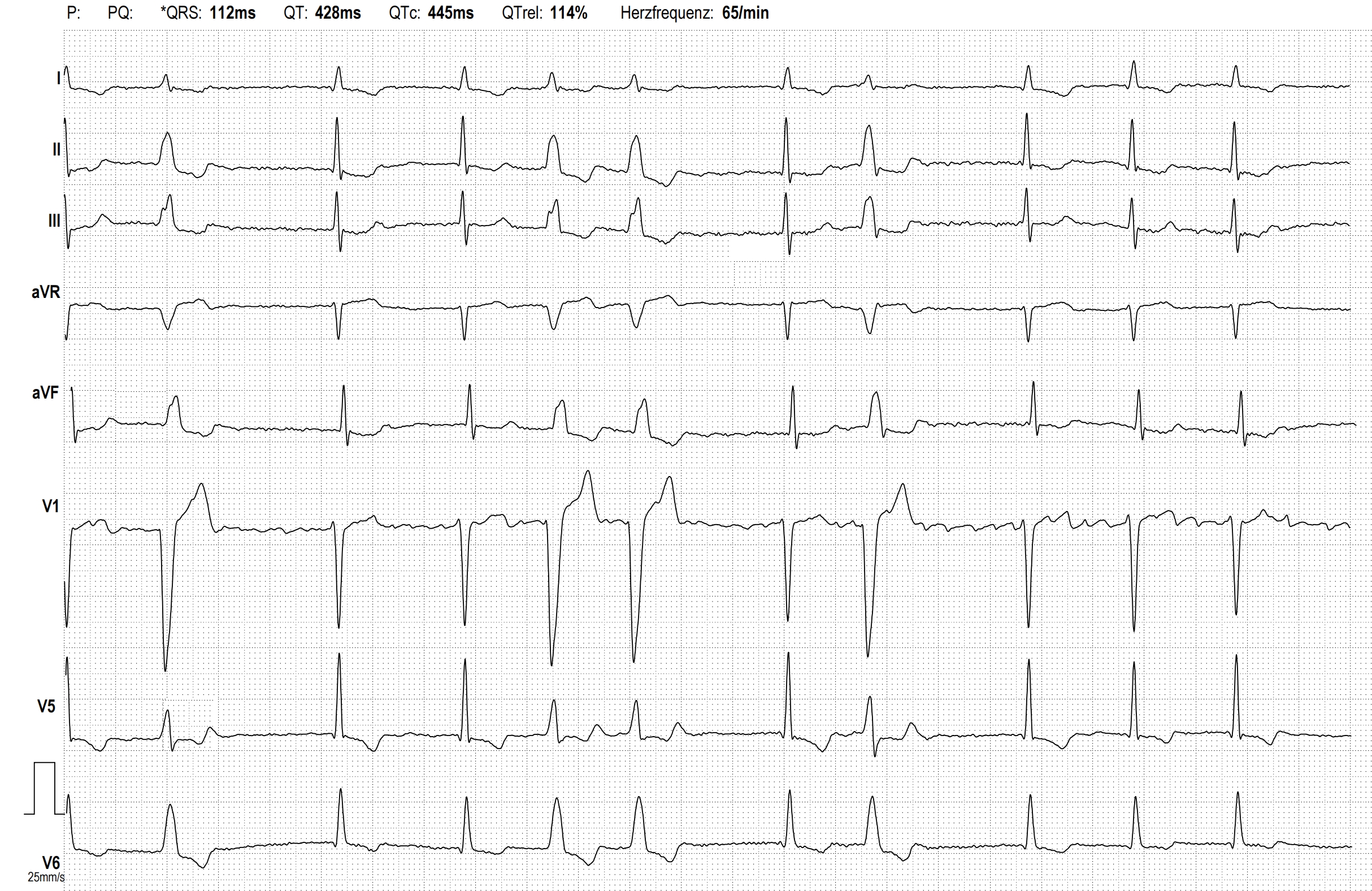 Atrial Fibrillation Ecg Guru Instructor Resources